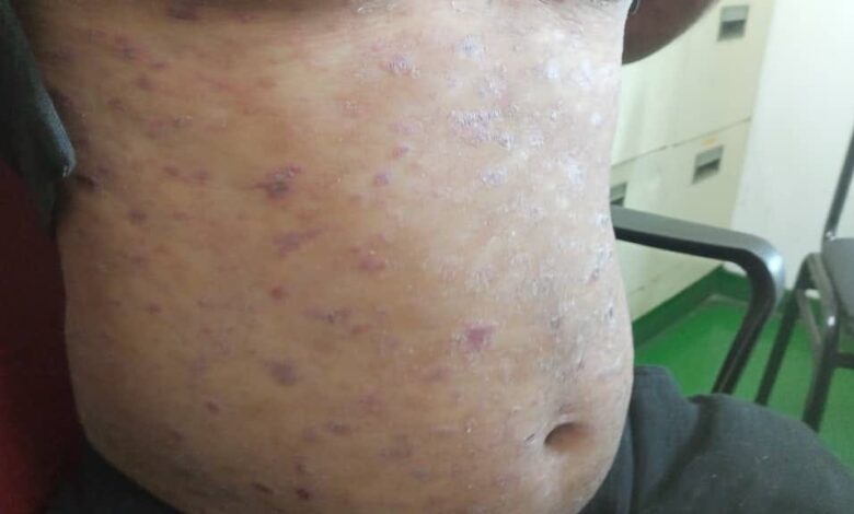 Yemen Records the First Case of Chickenpox - Yemen Monitor